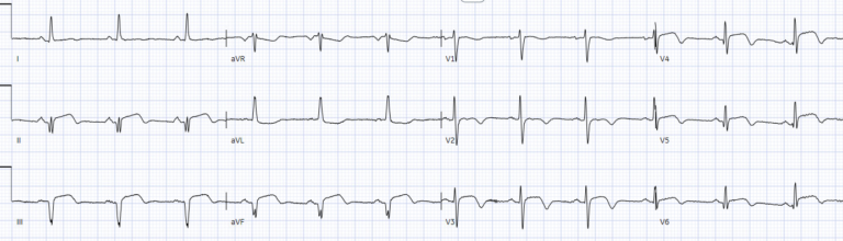Approach to Spontaneous Coronary Artery Dissection (SCAD) | EM Cases