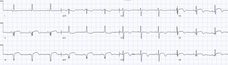 Approach to Spontaneous Coronary Artery Dissection (SCAD) | EM Cases