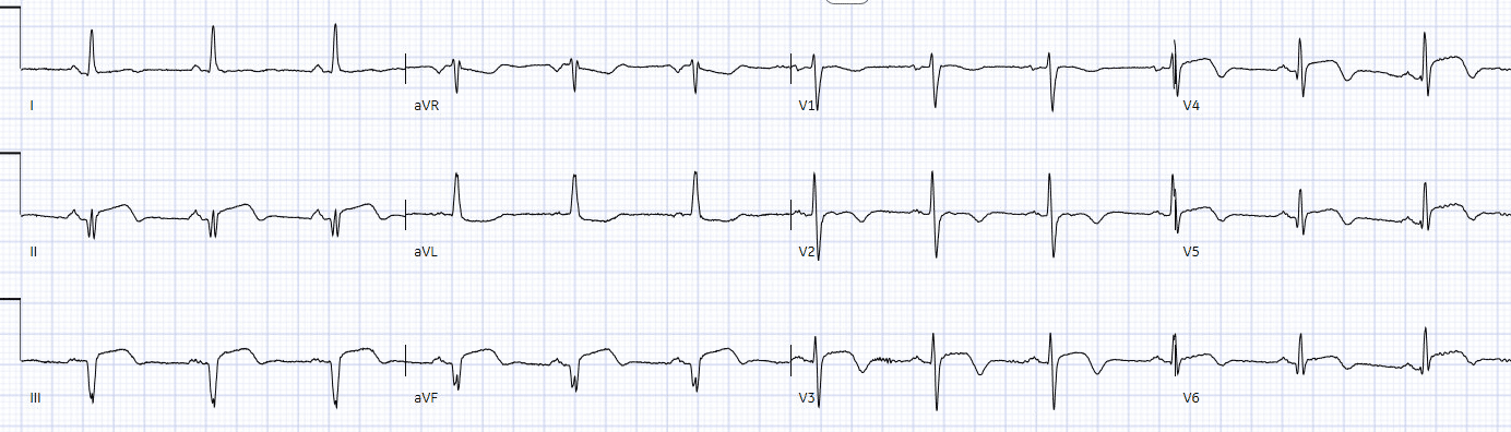 Approach to Spontaneous Coronary Artery Dissection (SCAD) | EM Cases