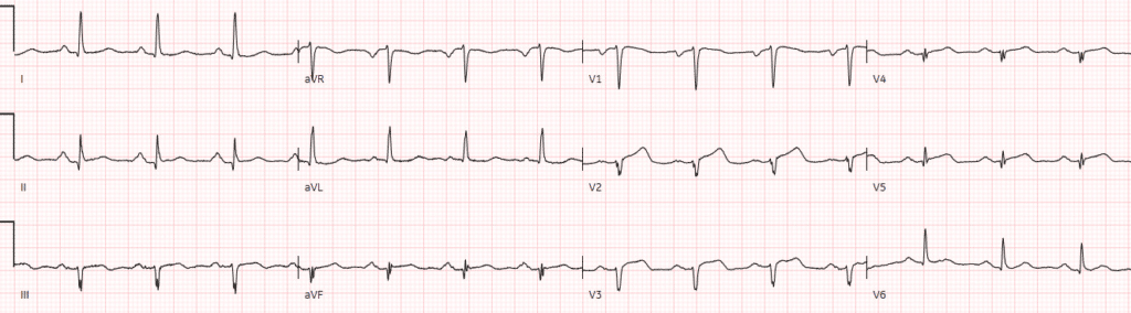 Approach to Spontaneous Coronary Artery Dissection (SCAD) | EM Cases