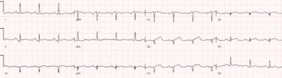 Approach to Spontaneous Coronary Artery Dissection (SCAD) | EM Cases