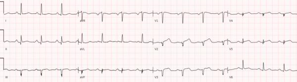 Approach to Spontaneous Coronary Artery Dissection (SCAD) | EM Cases
