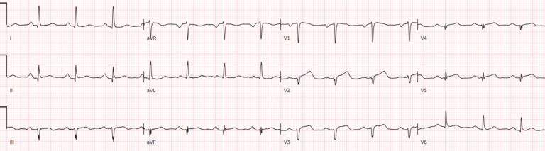 Approach to Spontaneous Coronary Artery Dissection (SCAD) | EM Cases