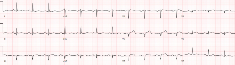 Approach to Spontaneous Coronary Artery Dissection (SCAD) | EM Cases