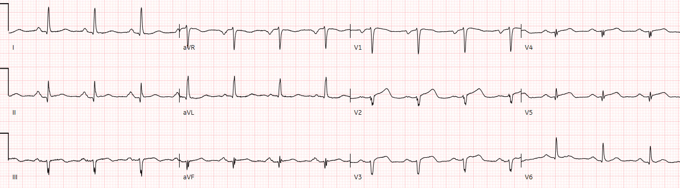 Approach to Spontaneous Coronary Artery Dissection (SCAD) | EM Cases