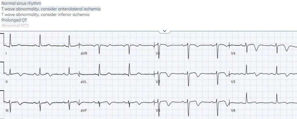 Approach to Spontaneous Coronary Artery Dissection (SCAD) | EM Cases
