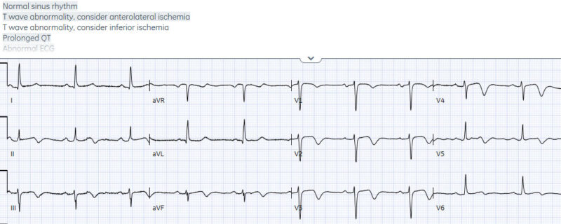 Approach to Spontaneous Coronary Artery Dissection (SCAD) | EM Cases