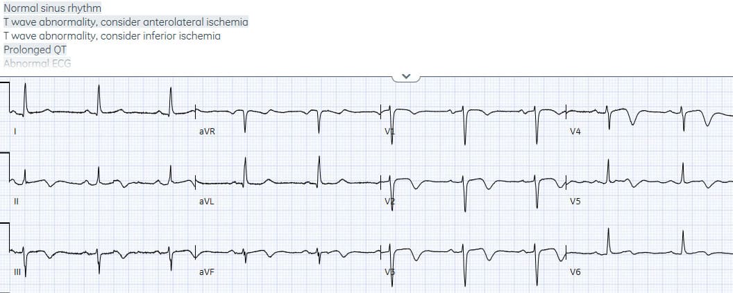 Approach to Spontaneous Coronary Artery Dissection (SCAD) | EM Cases