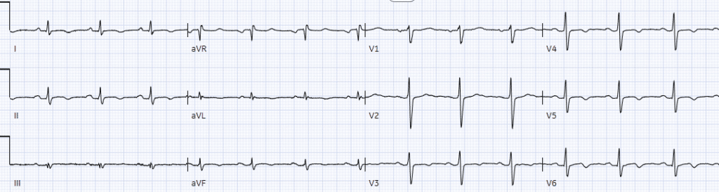 Approach to Spontaneous Coronary Artery Dissection (SCAD) | EM Cases