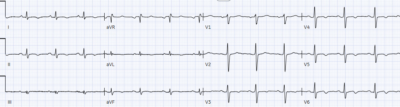 Approach to Spontaneous Coronary Artery Dissection (SCAD) | EM Cases