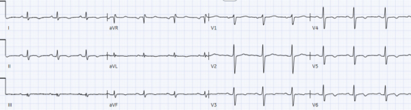 Approach to Spontaneous Coronary Artery Dissection (SCAD) | EM Cases