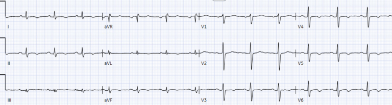 Approach to Spontaneous Coronary Artery Dissection (SCAD) | EM Cases