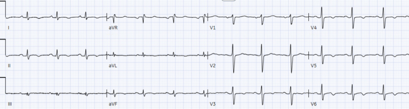 Approach to Spontaneous Coronary Artery Dissection (SCAD) | EM Cases