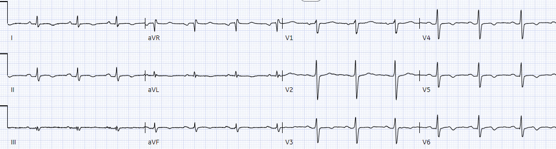 Approach to Spontaneous Coronary Artery Dissection (SCAD) | EM Cases