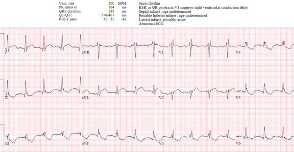 Approach to Spontaneous Coronary Artery Dissection (SCAD) | EM Cases