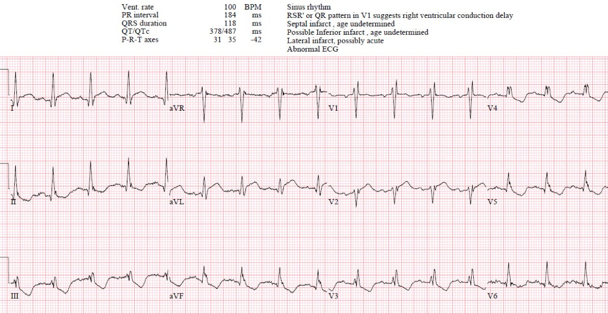 Approach to Spontaneous Coronary Artery Dissection (SCAD) | EM Cases