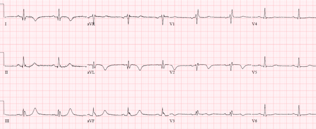 Approach to Spontaneous Coronary Artery Dissection (SCAD) | EM Cases