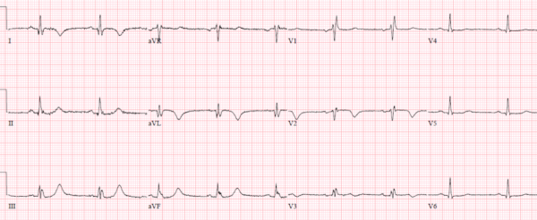Approach to Spontaneous Coronary Artery Dissection (SCAD) | EM Cases