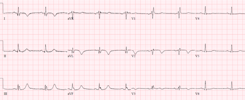 Approach to Spontaneous Coronary Artery Dissection (SCAD) | EM Cases