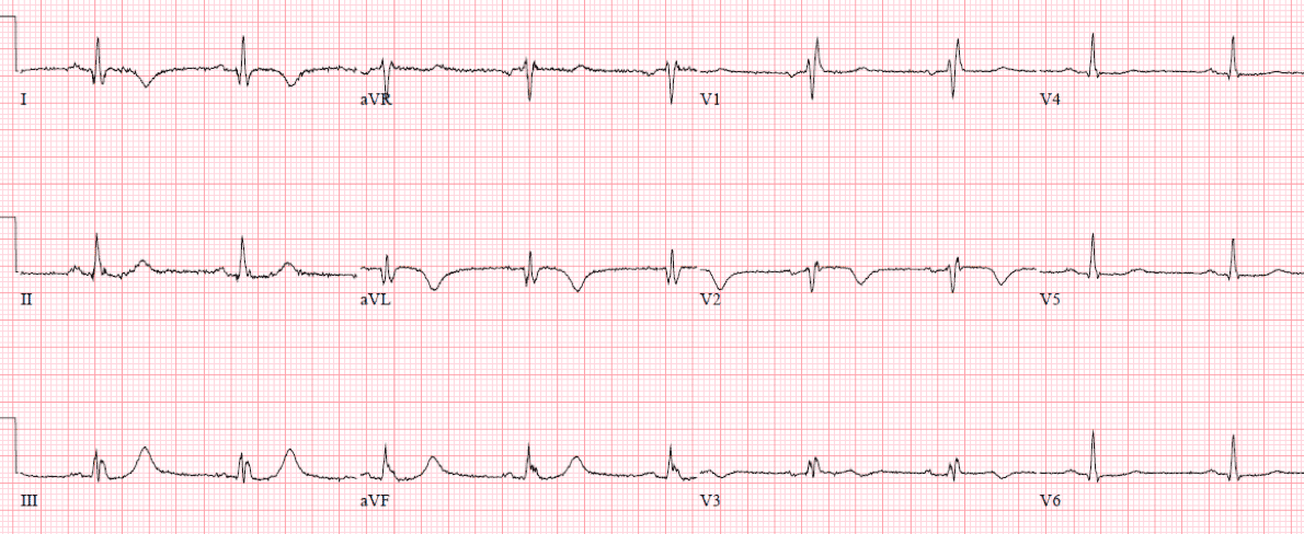 Approach to Spontaneous Coronary Artery Dissection (SCAD) | EM Cases