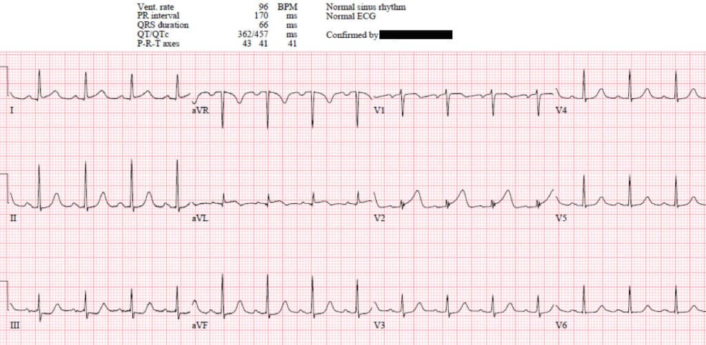 Approach to Spontaneous Coronary Artery Dissection (SCAD) | EM Cases