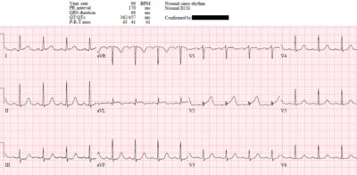 Approach to Spontaneous Coronary Artery Dissection (SCAD) | EM Cases