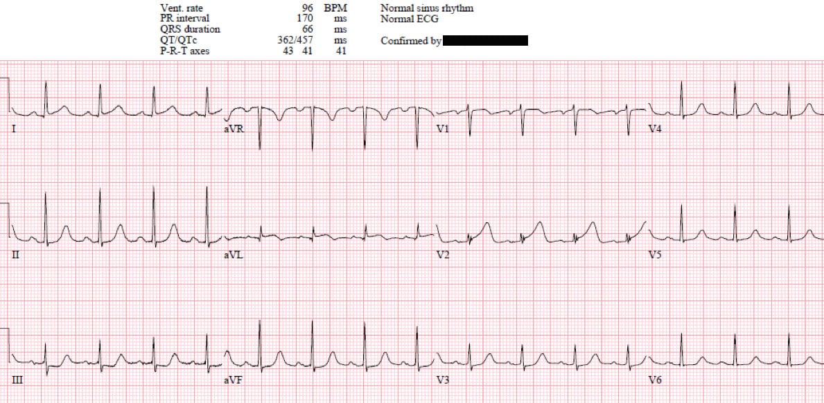Approach to Spontaneous Coronary Artery Dissection (SCAD) | EM Cases