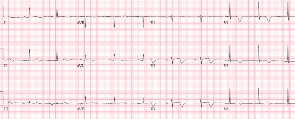 Approach to Spontaneous Coronary Artery Dissection (SCAD) | EM Cases