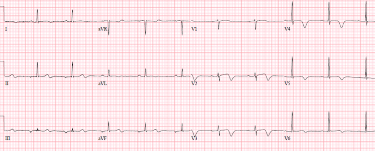 Approach to Spontaneous Coronary Artery Dissection (SCAD) | EM Cases