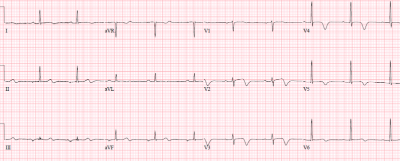 Approach to Spontaneous Coronary Artery Dissection (SCAD) | EM Cases