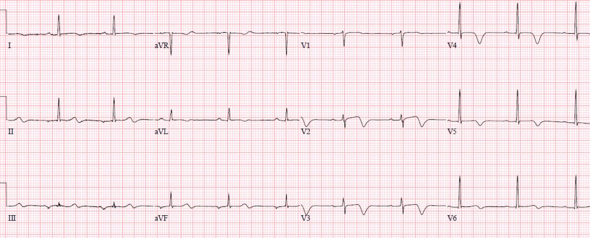 Approach to Spontaneous Coronary Artery Dissection (SCAD) | EM Cases