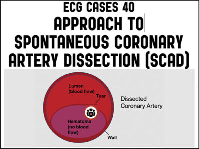 Approach to Spontaneous Coronary Artery Dissection (SCAD) | EM Cases
