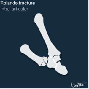 Hand Injuries - Finger Tip Injuries, Jersey Finger, PIP Dislocations ...