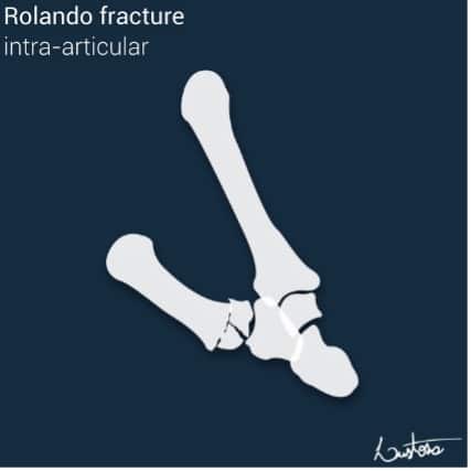 Hand Injuries - Finger Tip Injuries, Jersey Finger, PIP Dislocations ...