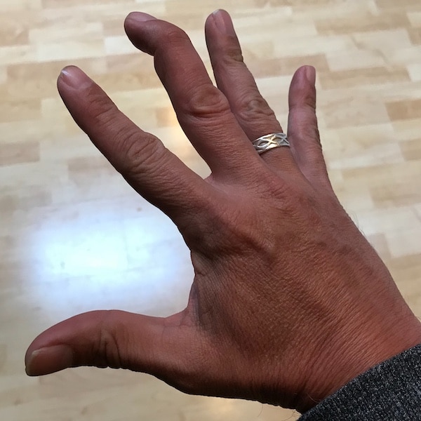 Hand Injuries - Finger Tip Injuries, Jersey Finger, PIP Dislocations ...