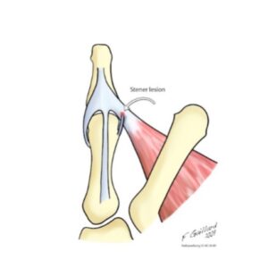 Hand Injuries - Finger Tip Injuries, Jersey Finger, PIP Dislocations ...