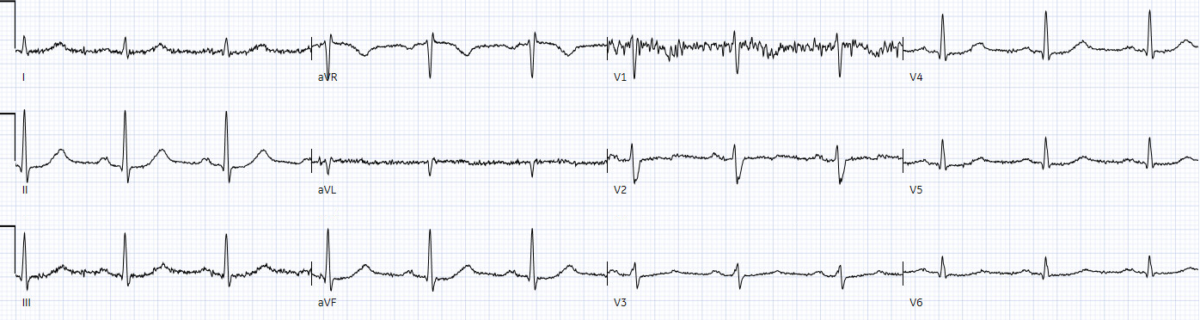 ECG Cases 41 - STEMI, Occlusion MI Complications
