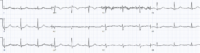 ECG Cases 41 - STEMI, Occlusion MI Complications