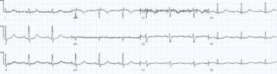 ECG Cases 41 - STEMI, Occlusion MI Complications