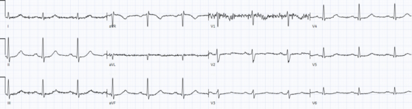 ECG Cases 41 - STEMI, Occlusion MI Complications