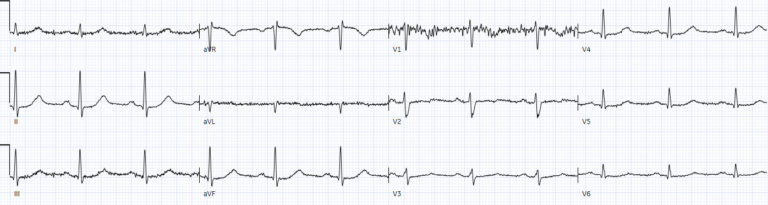 ECG Cases 41 - STEMI, Occlusion MI Complications