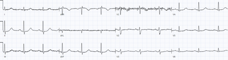 ECG Cases 41 - STEMI, Occlusion MI Complications