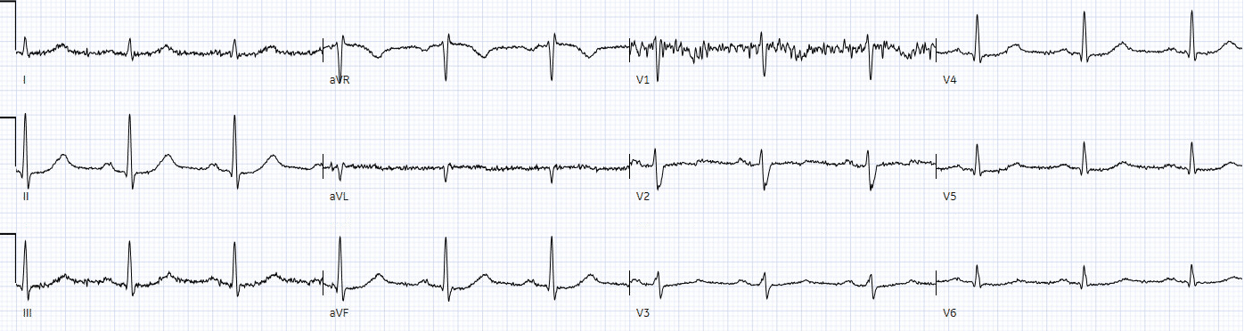 ECG Cases 41 - STEMI, Occlusion MI Complications