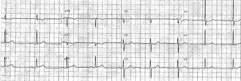 ECG Cases 41 - STEMI, Occlusion MI Complications