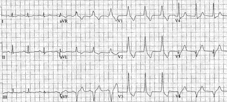 ECG Cases 41 - STEMI, Occlusion MI Complications