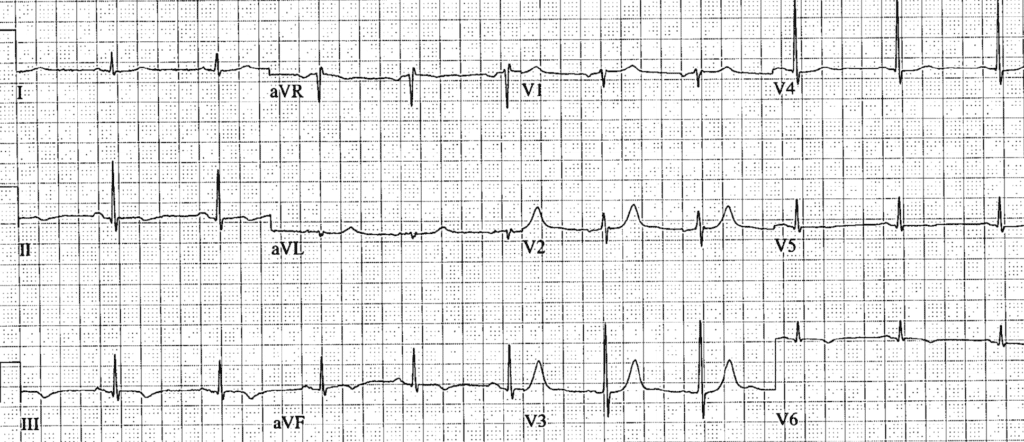 ECG Cases 41 - STEMI, Occlusion MI Complications
