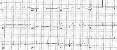 ECG Cases 41 - STEMI, Occlusion MI Complications