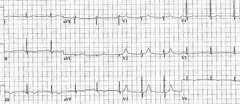 ECG Cases 41 - STEMI, Occlusion MI Complications