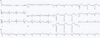 ECG Cases 41 - STEMI, Occlusion MI Complications