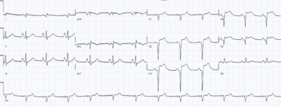 ECG Cases 41 - STEMI, Occlusion MI Complications